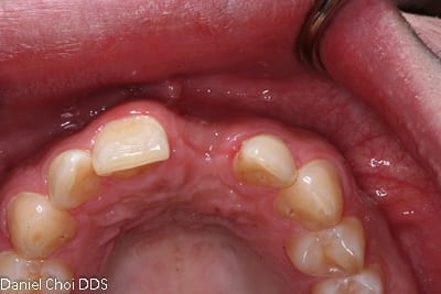 Ridge Augmentation and Guided Bone Regeneration - North Texas Dental ...