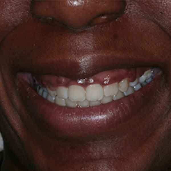 Esthetic Crown Lengthening | Affordable Board Certified Surgeon ...