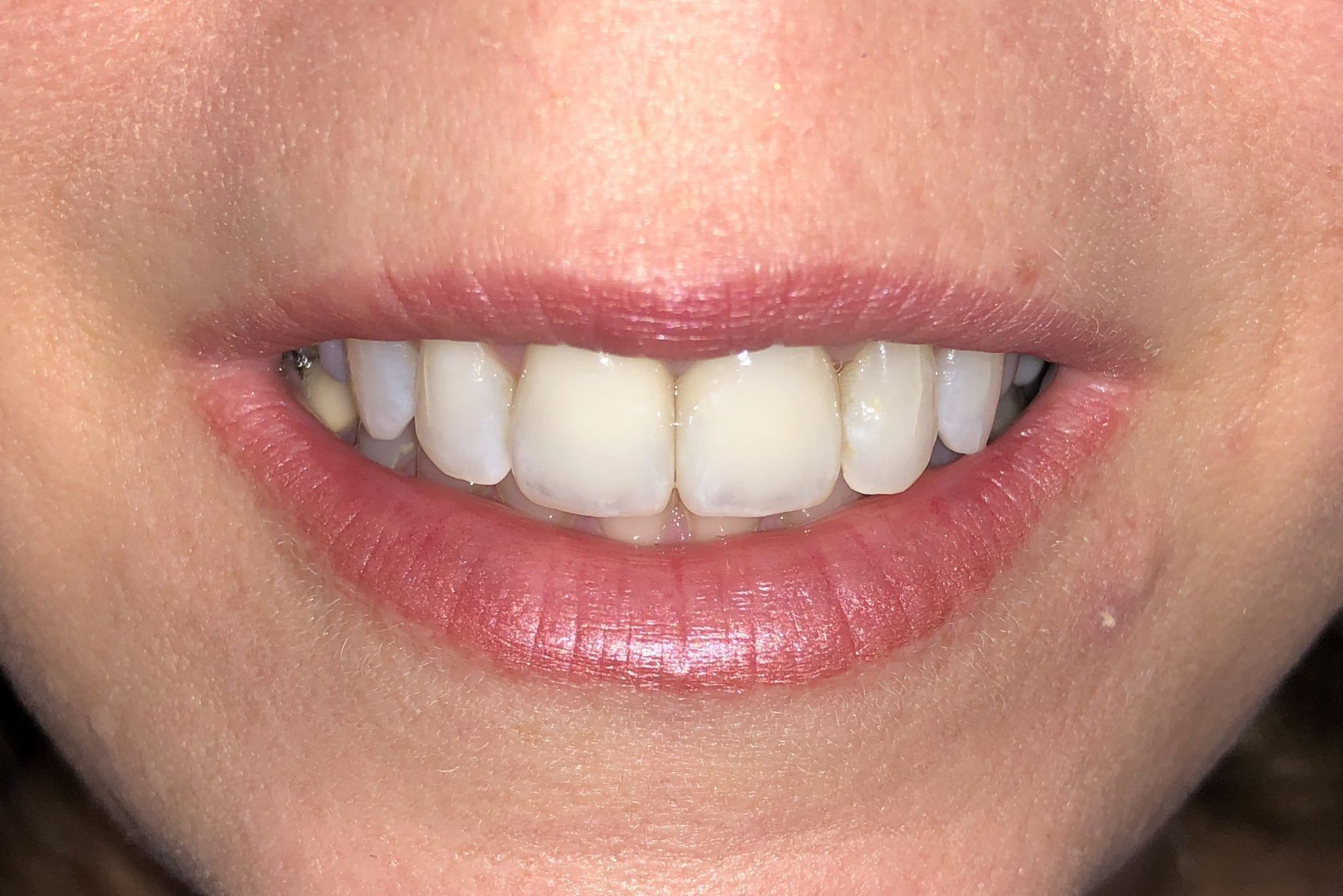 Dental Implants - North Texas Dental Surgery