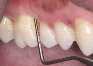 Gum Disease Options - North Texas Dental Surgery