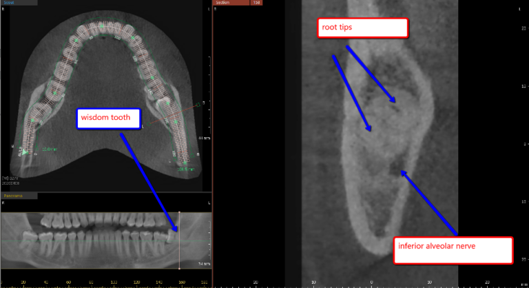 Wisdom Teeth Nerve Damage - North Texas Dental Surgery