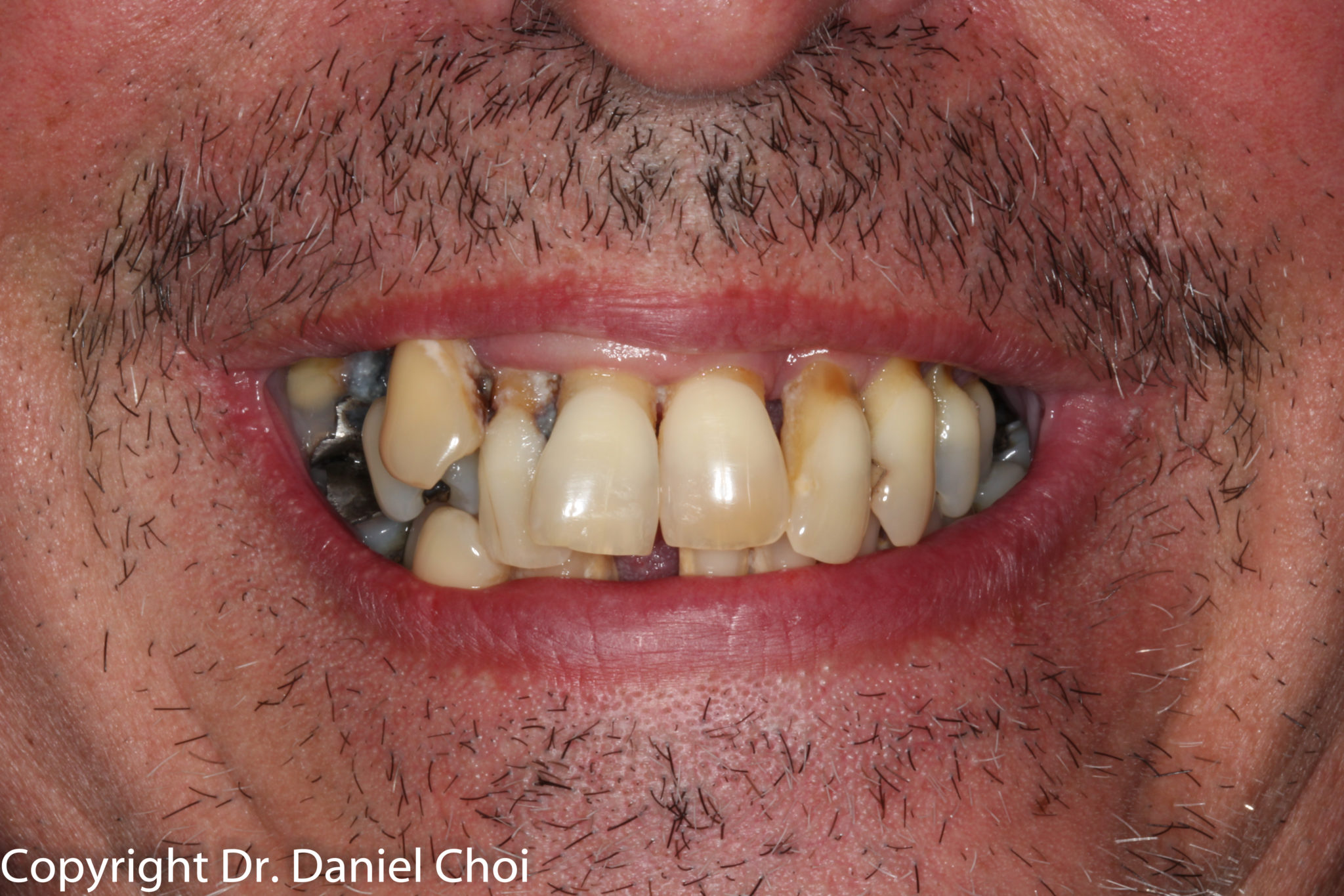 Snap-In Dentures | North Texas Dental Surgery