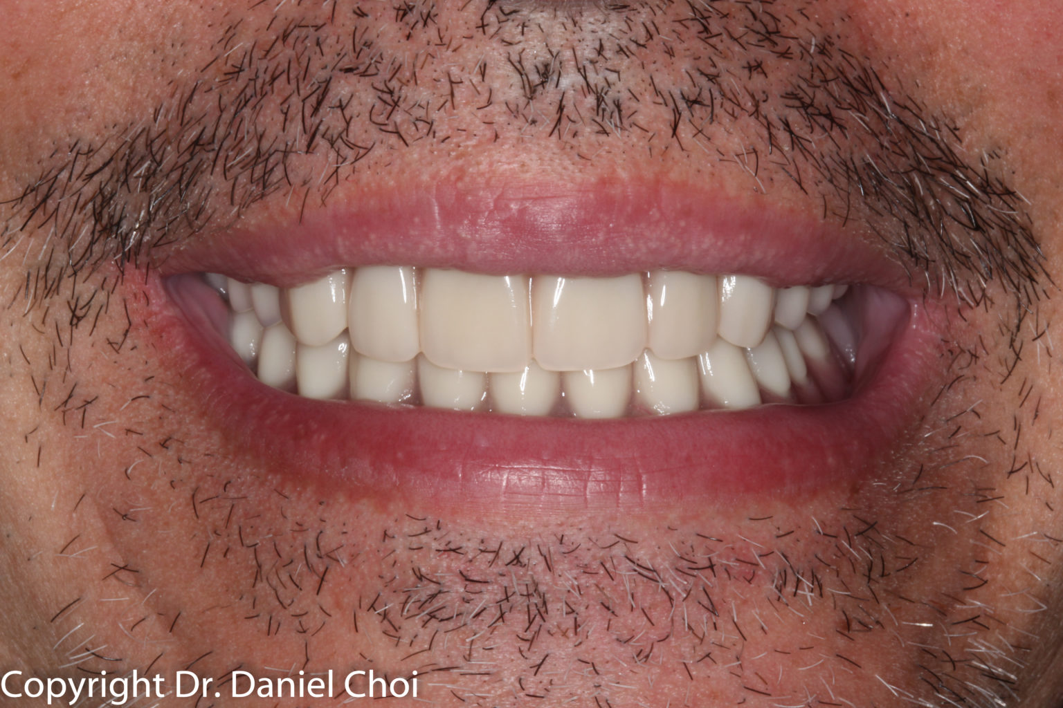 All on 4 | Denture Implants | North Texas Dental Surgery