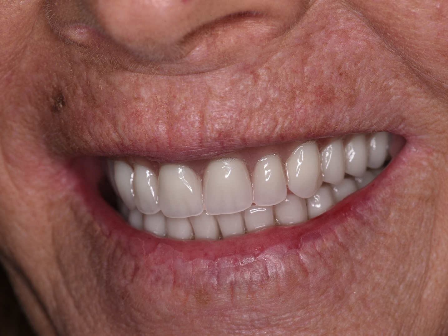 Implant Dentures Dallas, TX - North Texas Dental Surgery