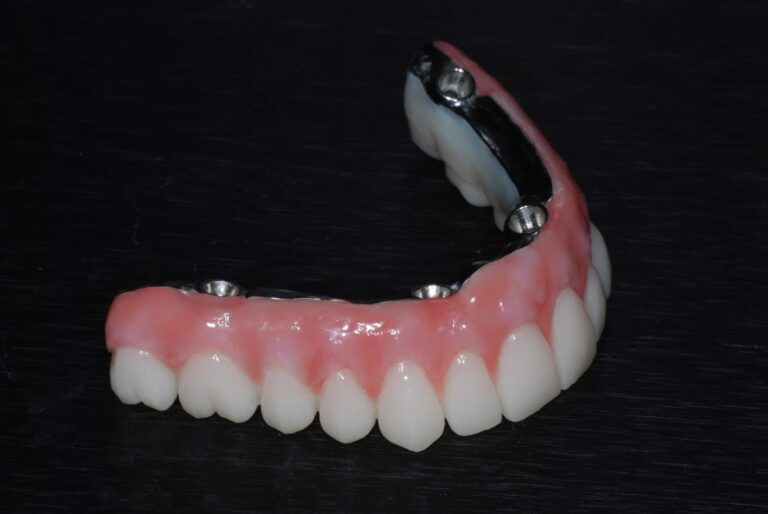 All on 4 Denture Implant Prosthesis Material - North Texas Dental Surgery