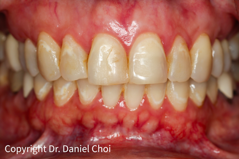 Receding Gums - North Texas Dental Surgery