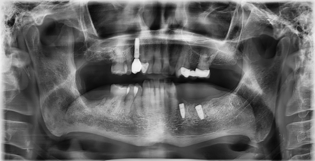 Oral Cancer and Dental Health - North Texas Dental Surgery