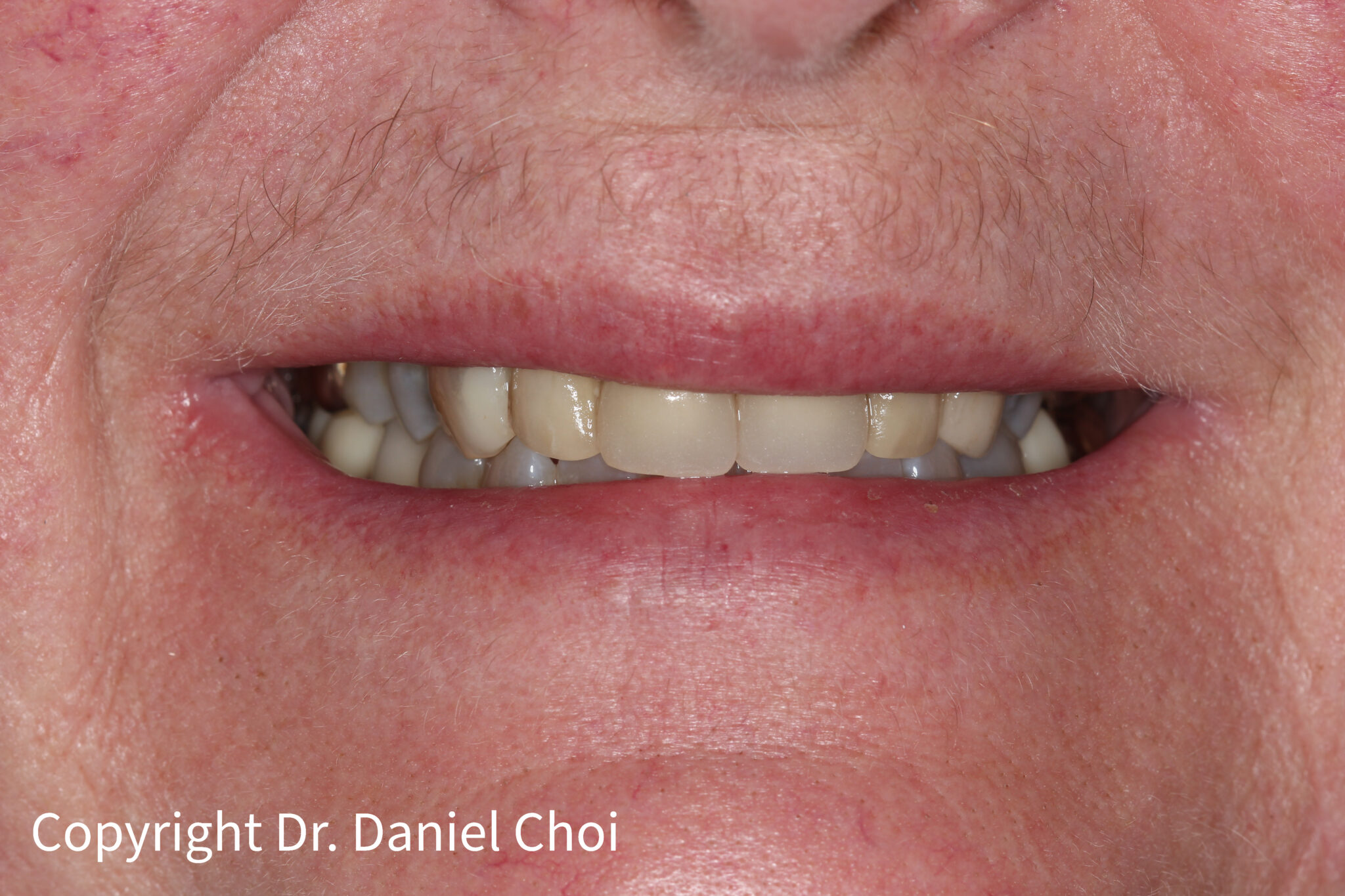 All on 4 | Denture Implants | North Texas Dental Surgery