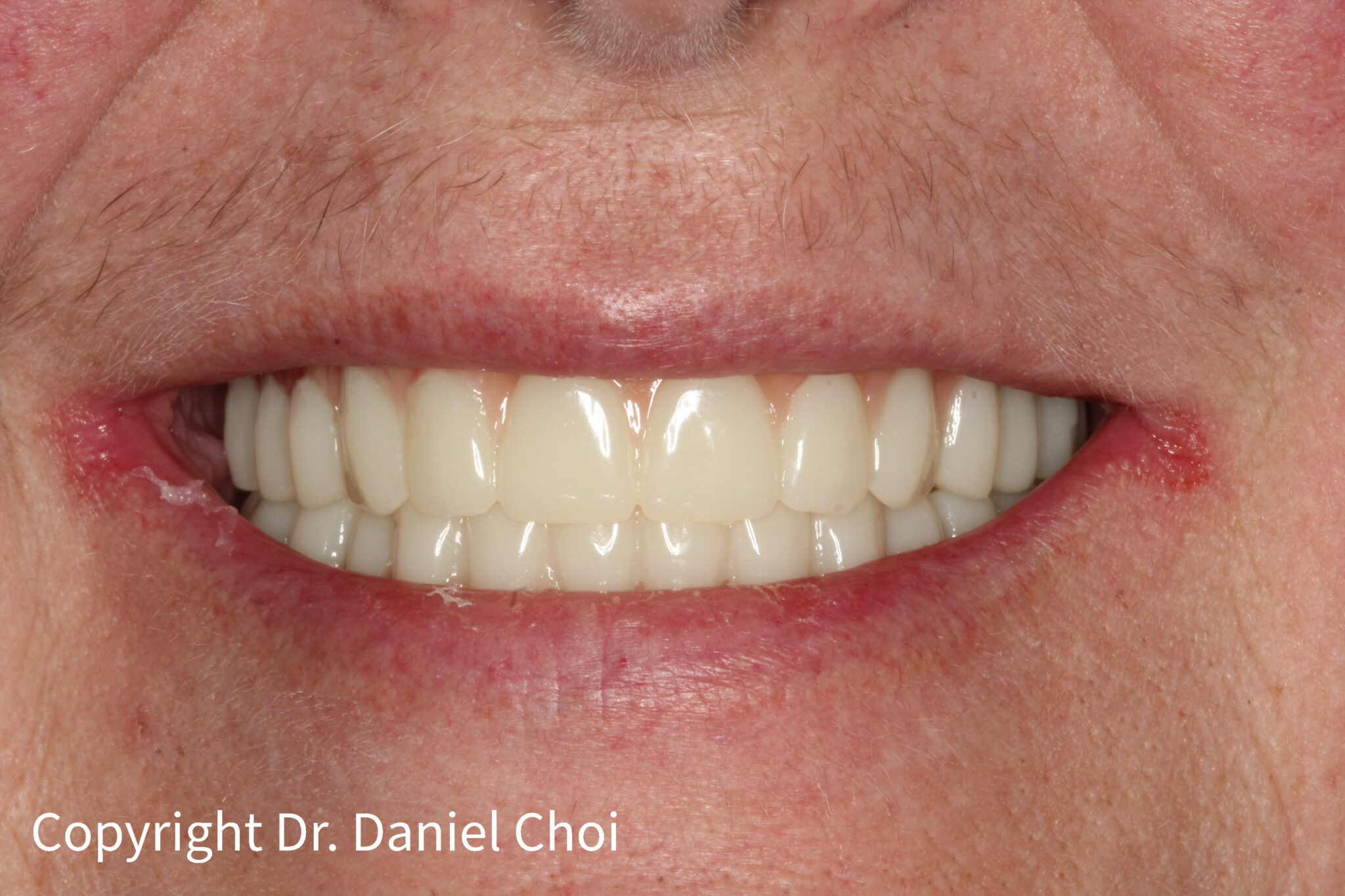 All on 4 | Denture Implants | North Texas Dental Surgery