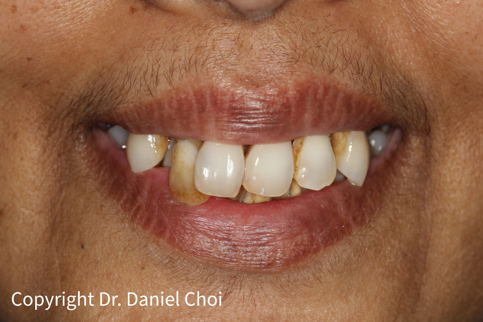 Dental Implants 101 Part 4 North Texas Dental Surgery