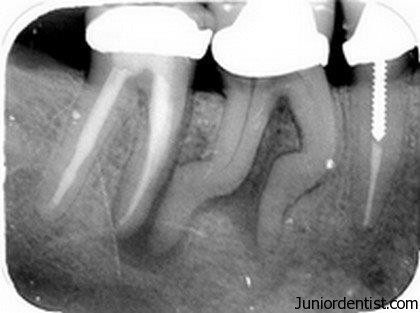 Dental Implants 101: Part 3 | North Texas Dental Surgery