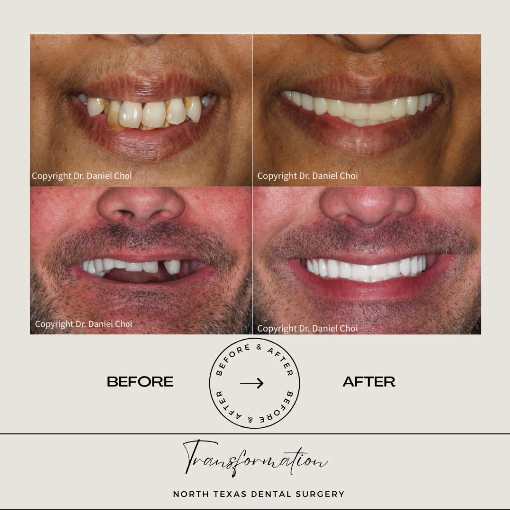 All on Four – Zirconia - North Texas Dental Surgery