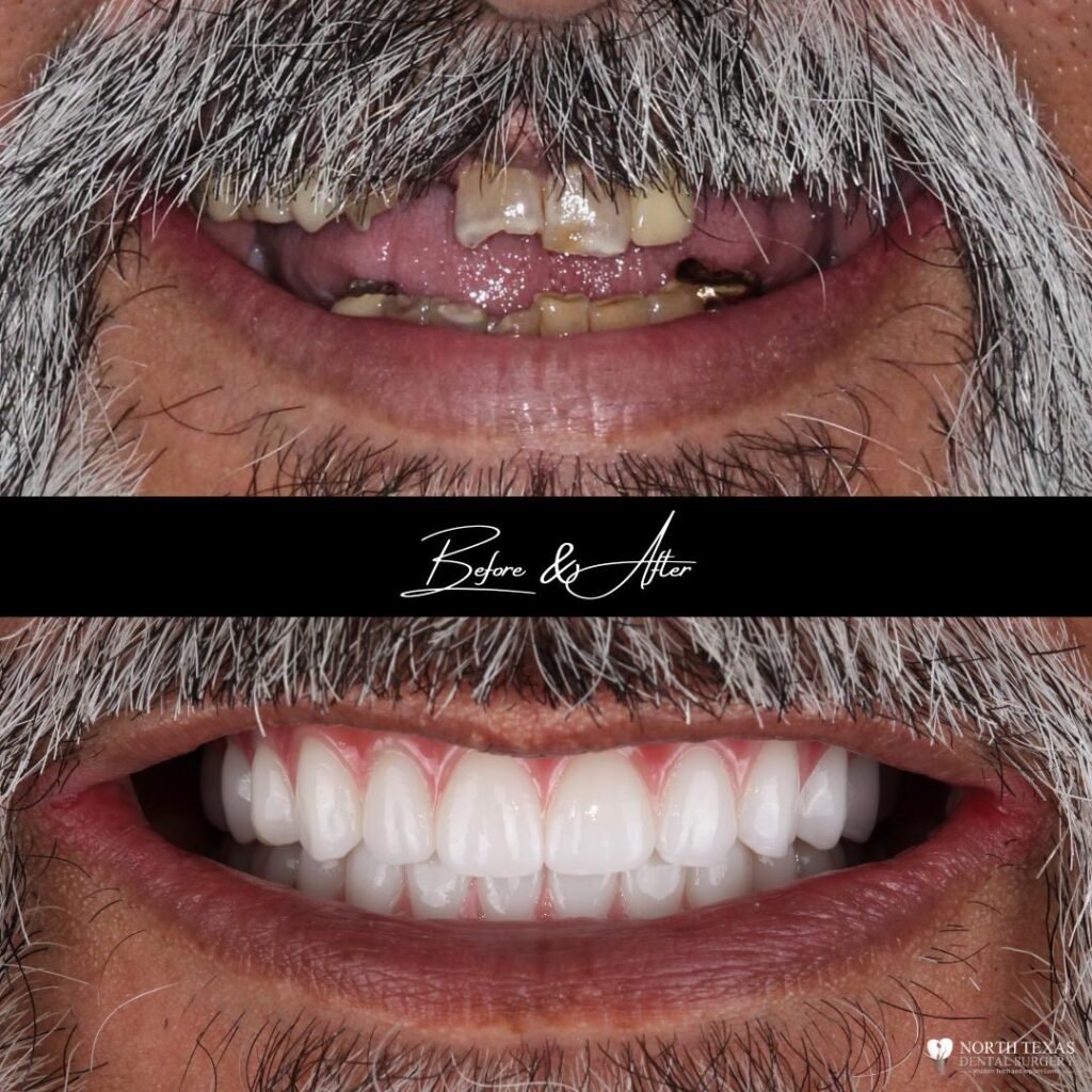 All on 4 - North Texas Dental Surgery