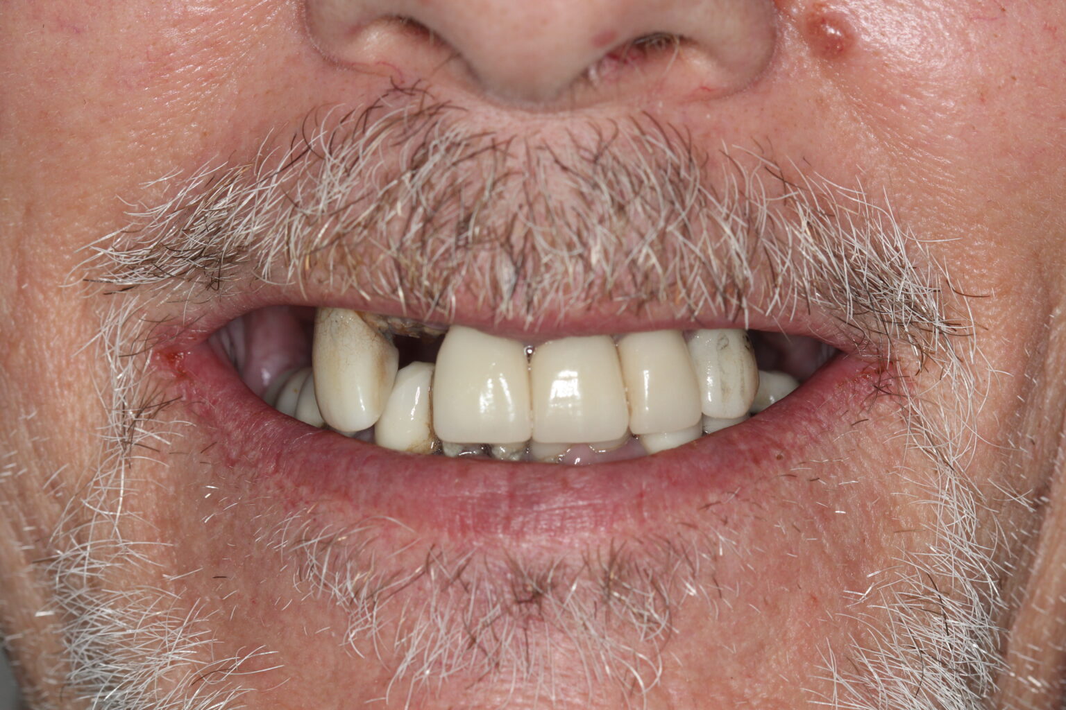 Before and After Results - North Texas Dental Surgery