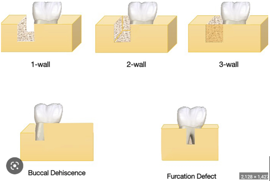 Dental Implants Everything You Need to Know About Bone Grafting - North ...