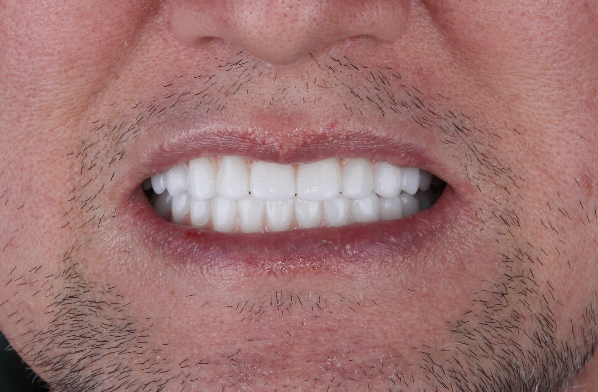 Before and After Results - North Texas Dental Surgery