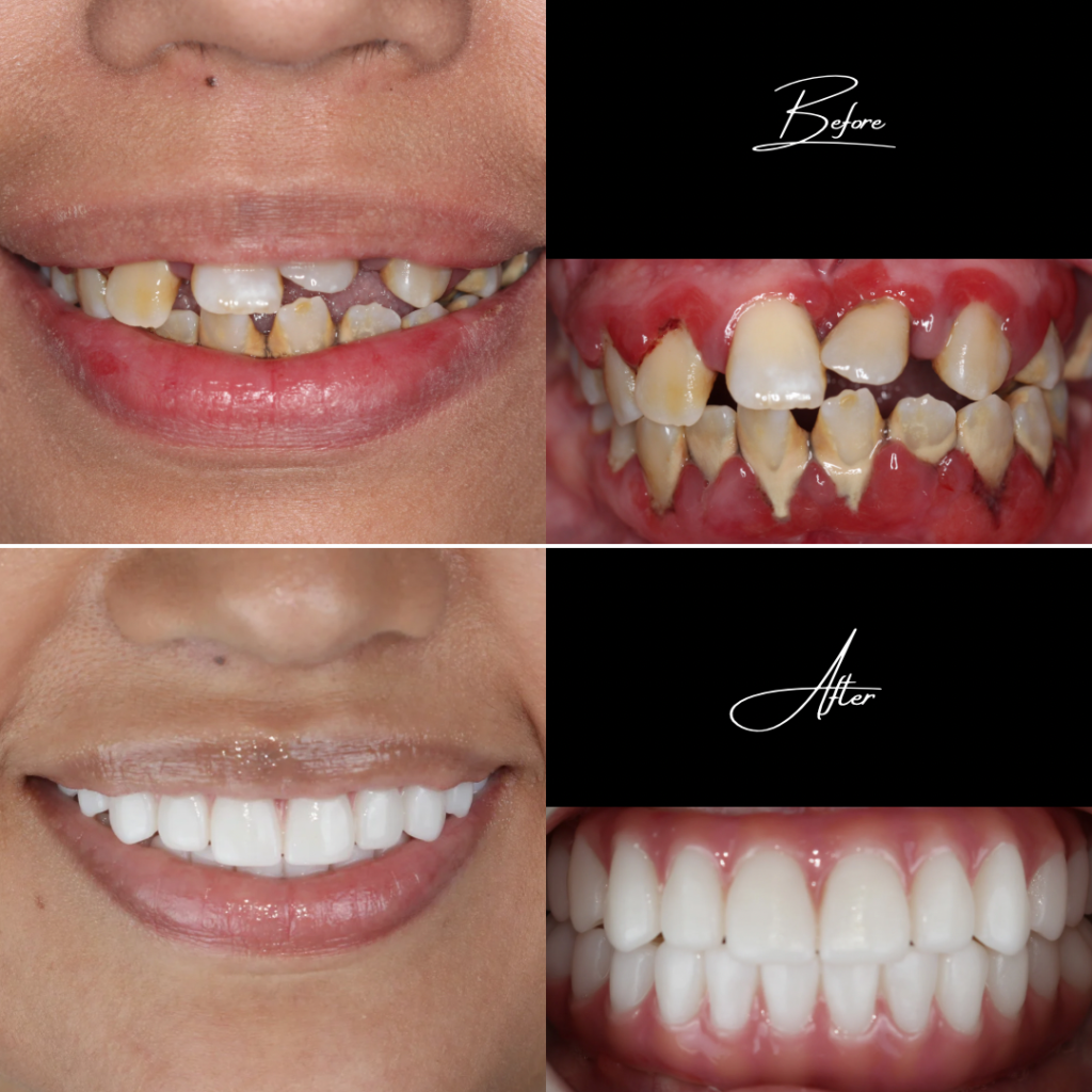 All on 4 - North Texas Dental Surgery